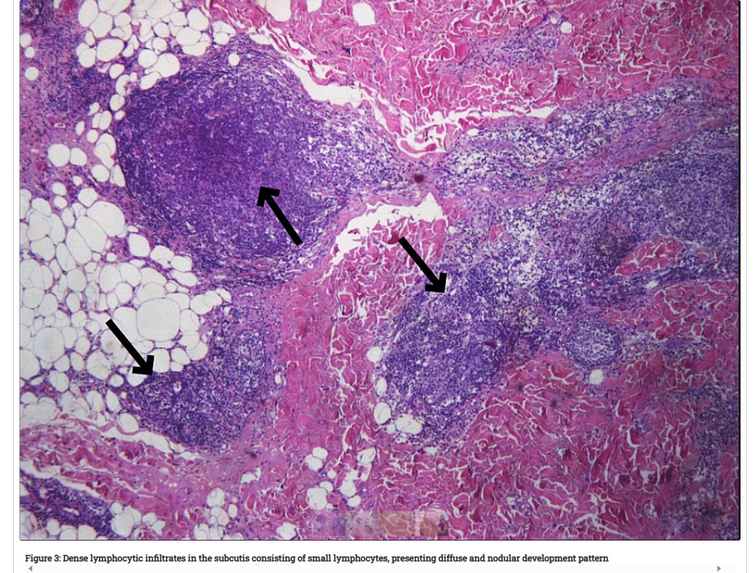 Chris Milbank on Twitter: "RT @VaccineMole: Pub 23 Apr 2023 Another pseudocancer after COV Vax ...
