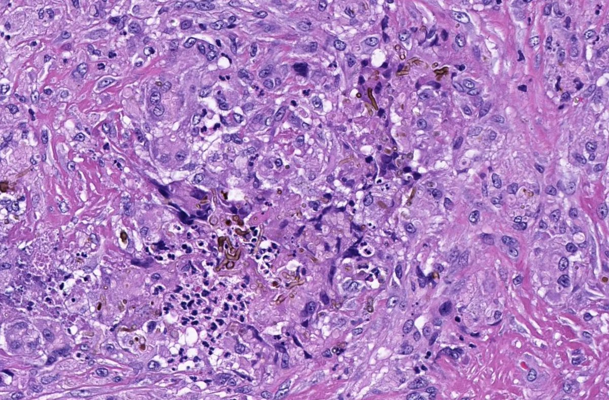 Jerad Gardner Md On Twitter Rt Kiko4docs Skin Biopsy Shared By Dr Vkazlouskaya Diagnosis