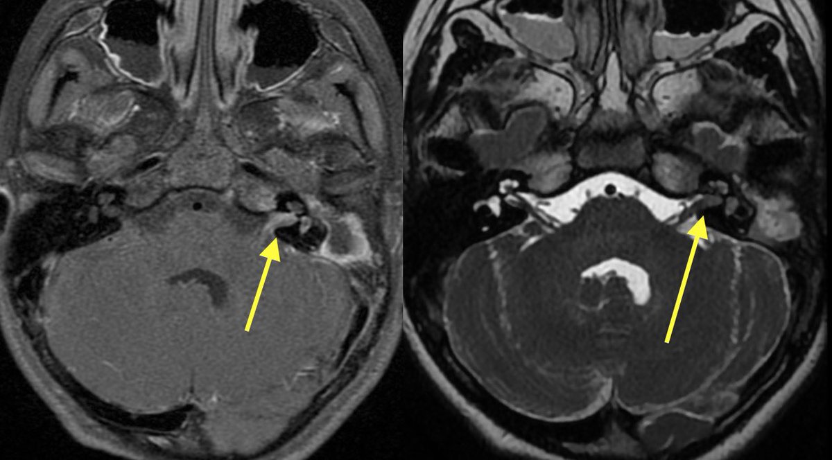 Complicated case in this patient with ear pain, fever, and headache # ...