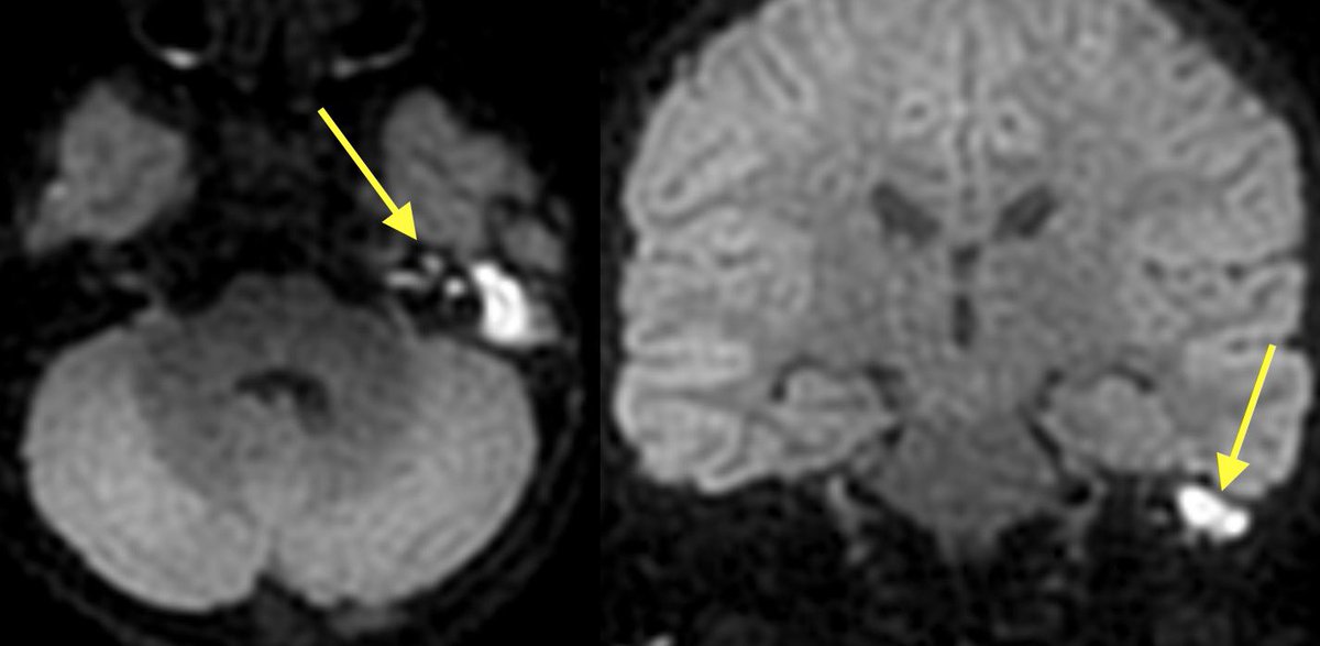 Complicated case in this patient with ear pain, fever, and headache # ...