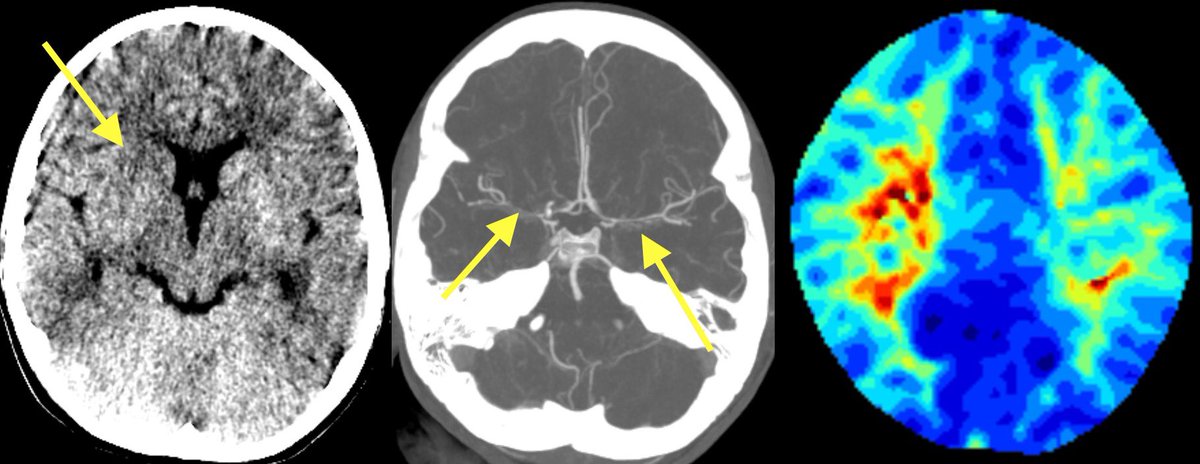 Complicated case in this patient with ear pain, fever, and headache # ...