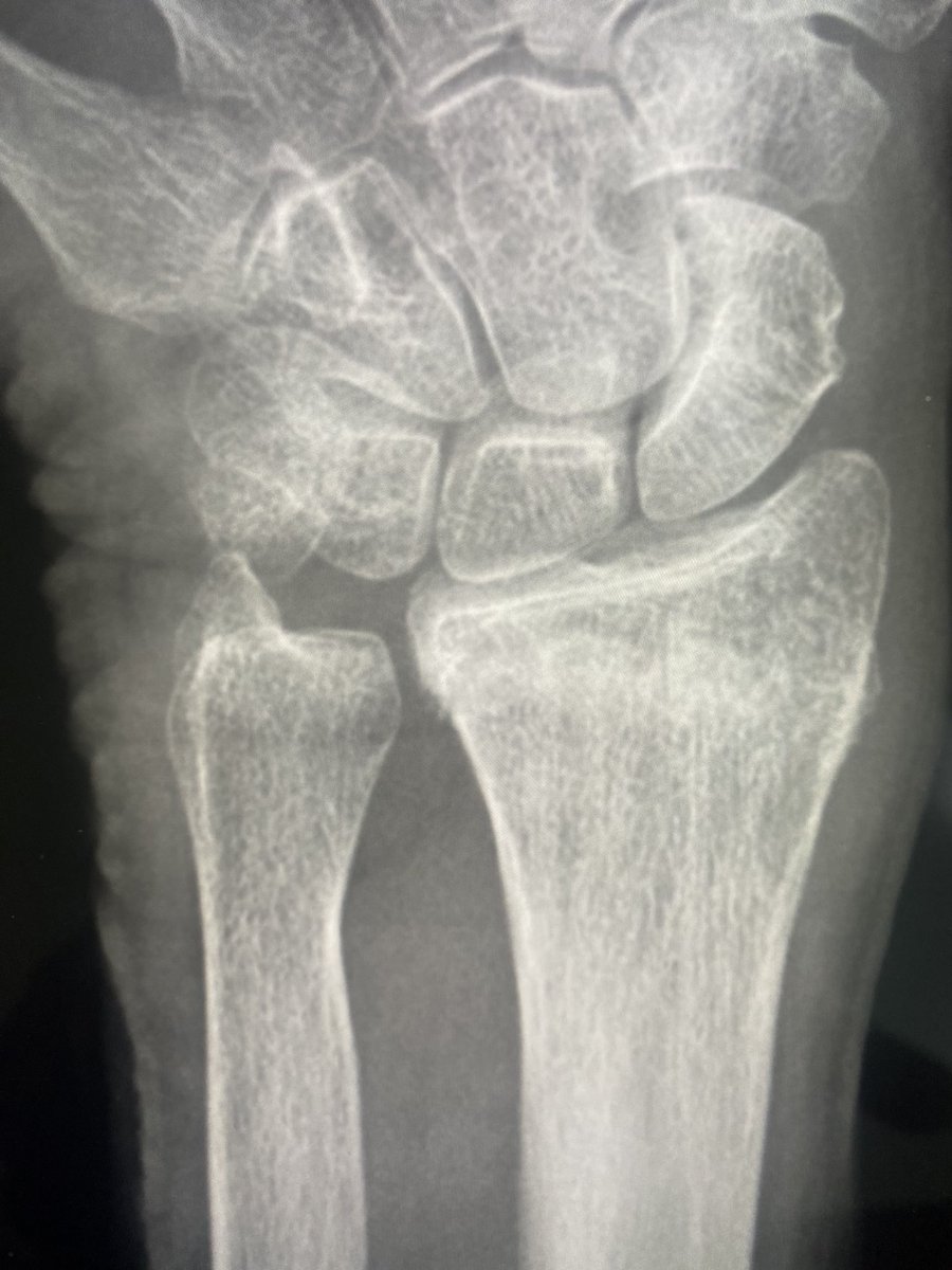 Impacted Distal Radius Fracture Hot Sex Picture