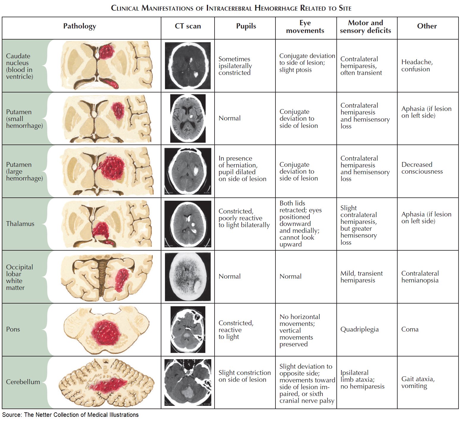 Intracerebral Hemorrhage