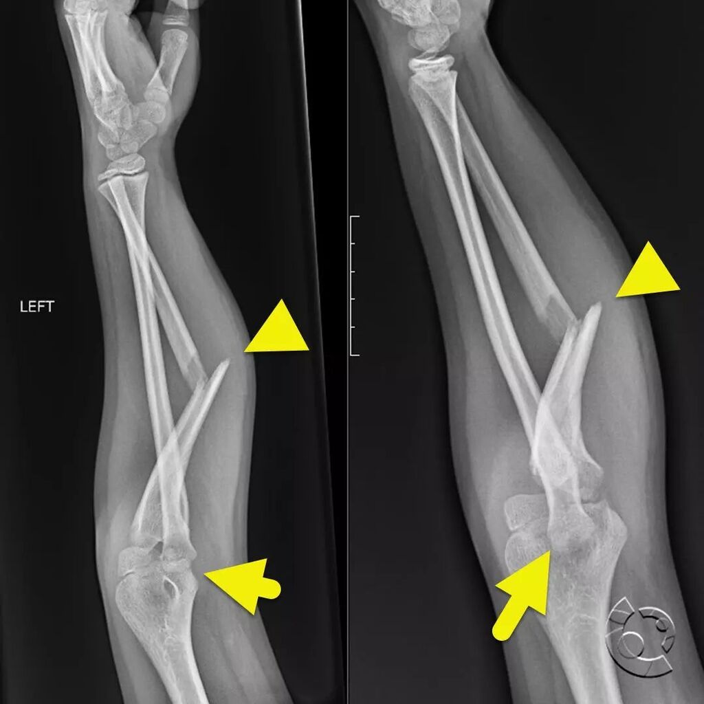 Left Elbow X Ray