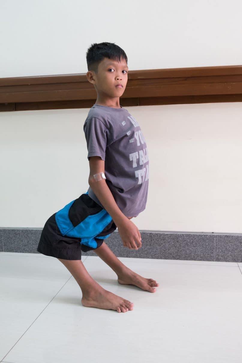 People With Backwards Legs