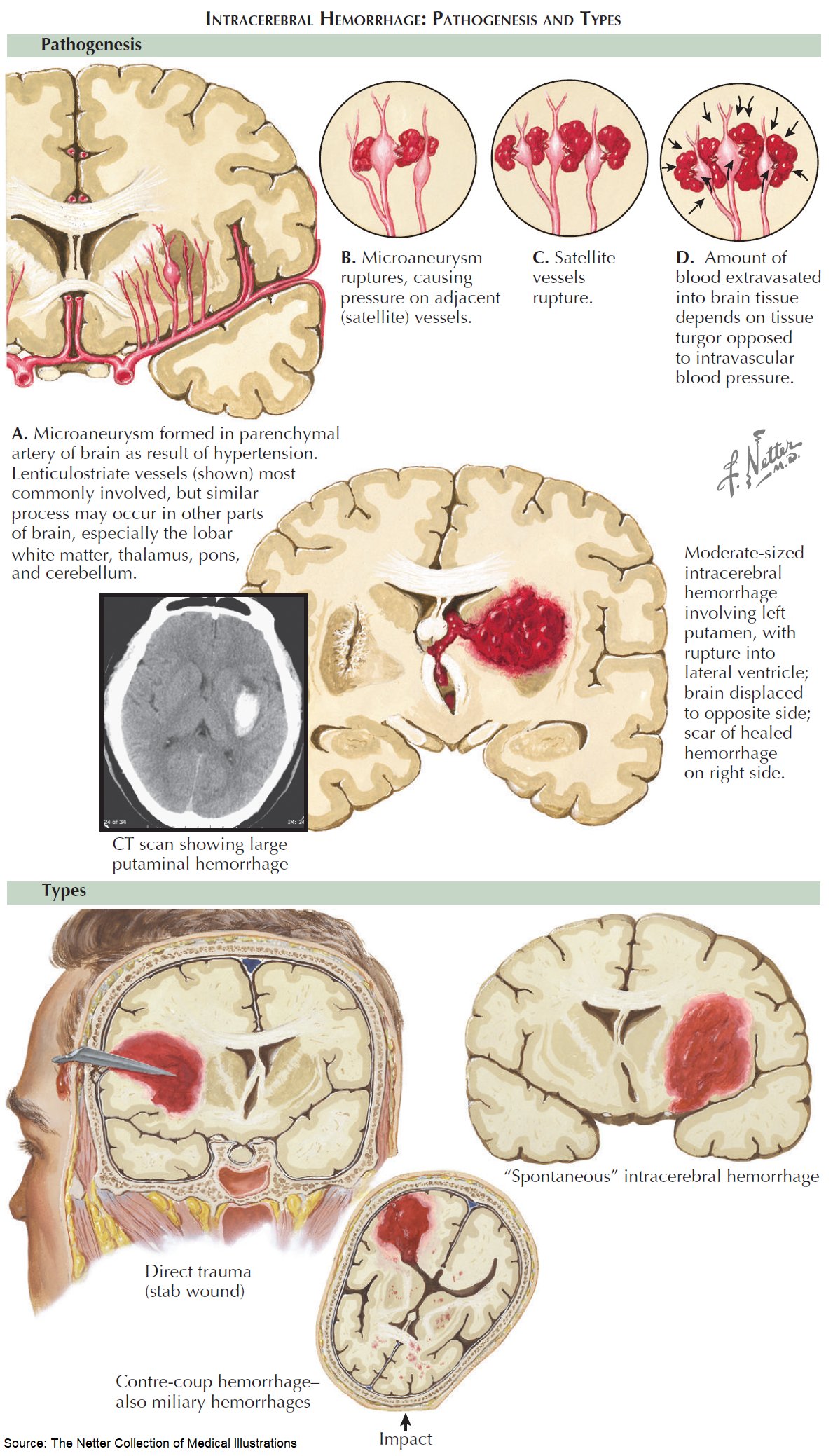 Intracerebral Hemorrhage