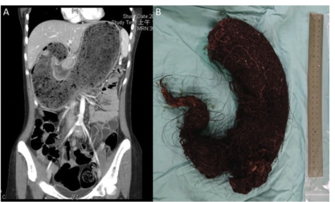 Oren Gottfried MD On Twitter A 16 year old Girl With Vomiting oren-gottfried-md-on-twitter-a-16-year-old-girl-with-vomiting