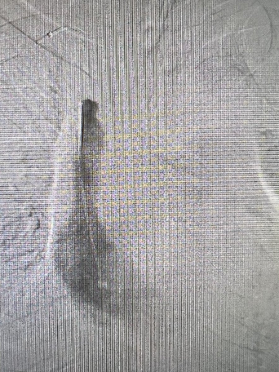 Nariman Nezami, MD on Twitter: "What do you use for your sharp recanalization & what stent do ...