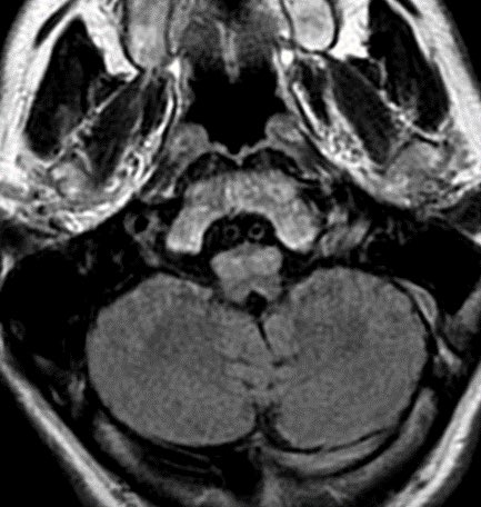 Hypertrophic Olivary Degeneration 🧠 Lesions that disrupt the triangle ...