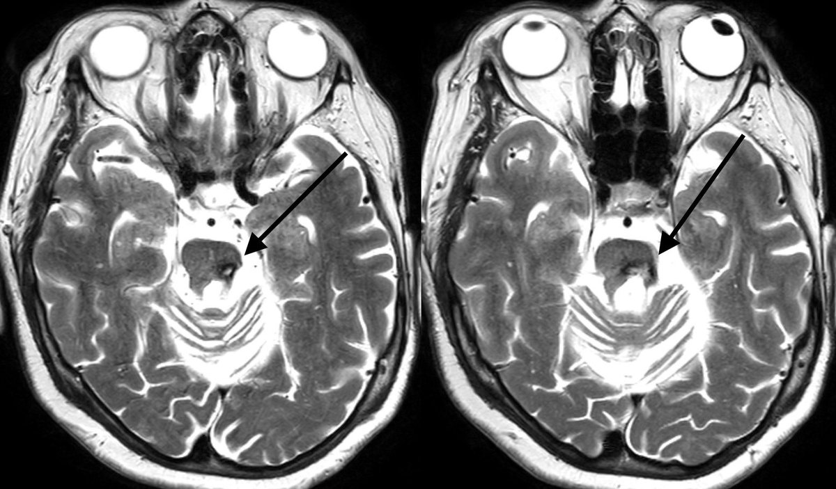 Hypertrophic Olivary Degeneration 🧠 Lesions that disrupt the triangle ...