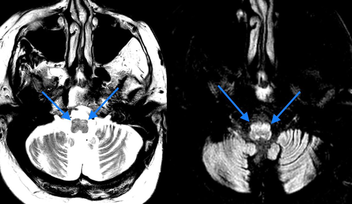 Hypertrophic Olivary Degeneration 🧠 Lesions that disrupt the triangle ...