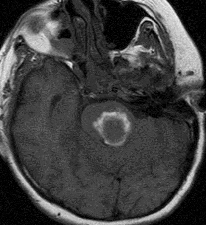 Hypertrophic Olivary Degeneration 🧠 Lesions that disrupt the triangle ...