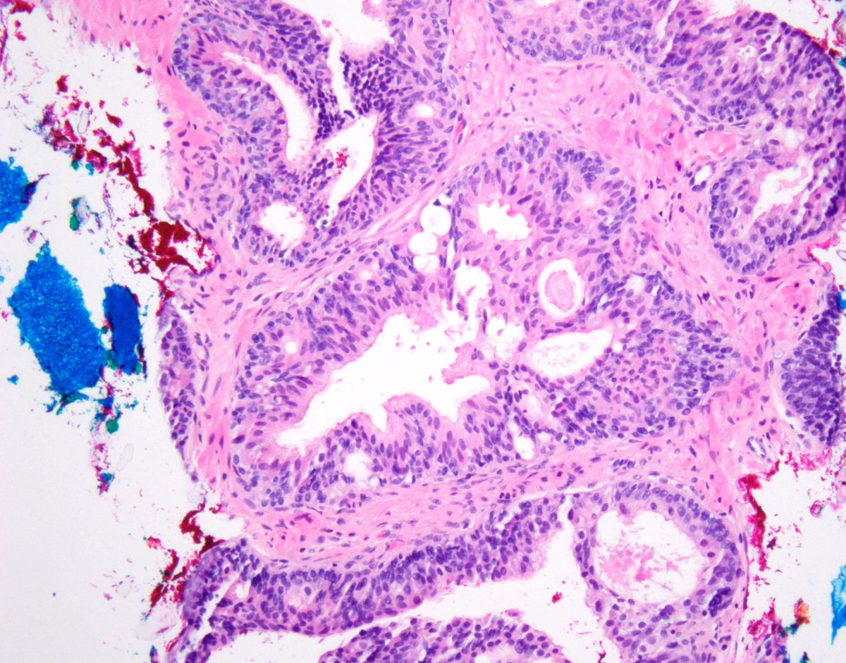 Jerad Gardner Md On Twitter Rt Kiko4docs Prostate Case Shared By
