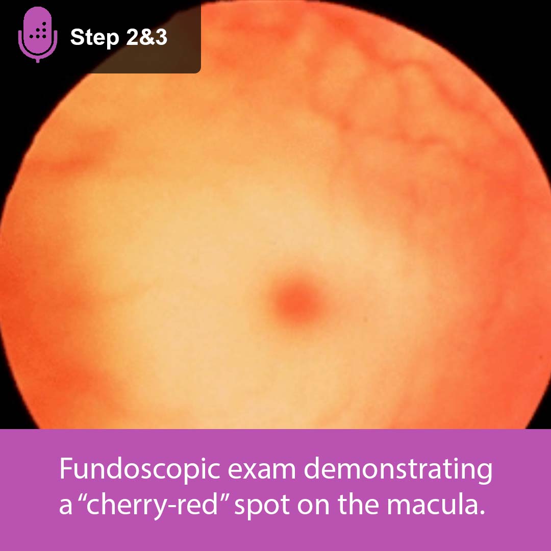 Cherry Red Macula Vs Normal Macula