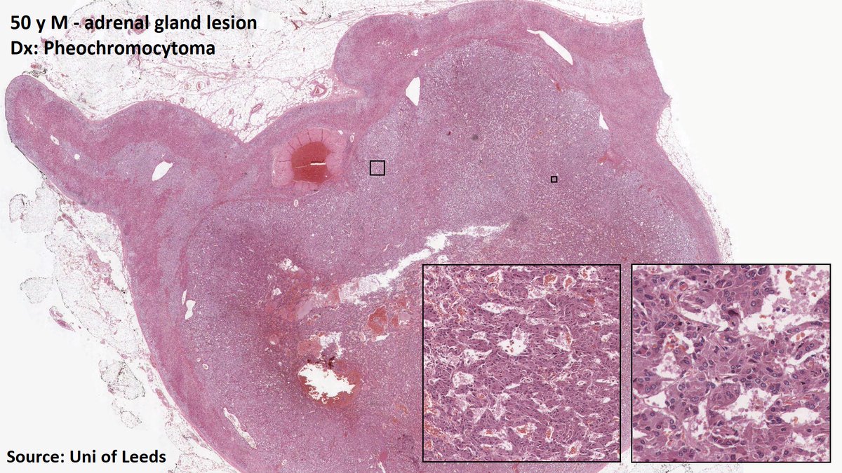 Dr Travis Brown 🎧 On Twitter Histology Flash Card Pheochromocytoma Rare Majority Sporadic 33