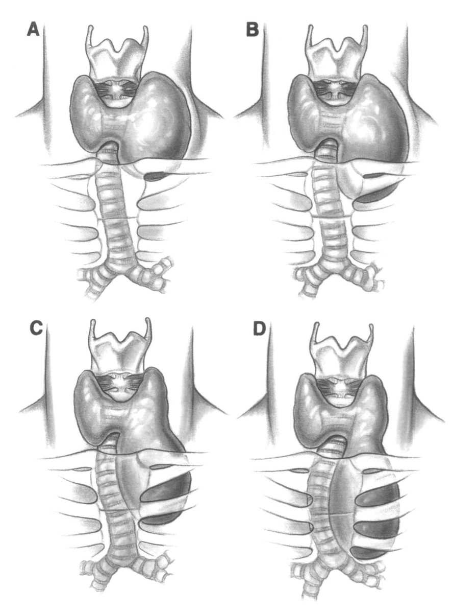 Thyroidectomy By Nursingcrib