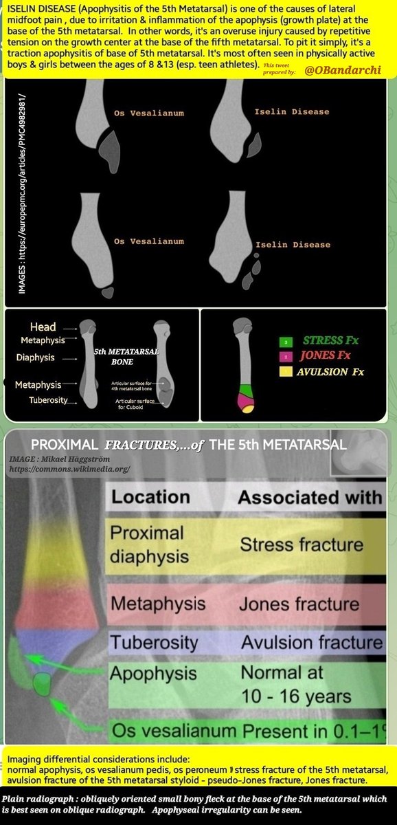 Dr.OMID BANDARCHI ,M.D. on Twitter: "🛑Iselin's disease🛑 described by Iselin in 1912. Apophysitis ...