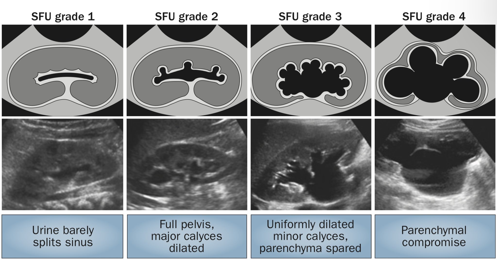 Hydronephrosis Grade