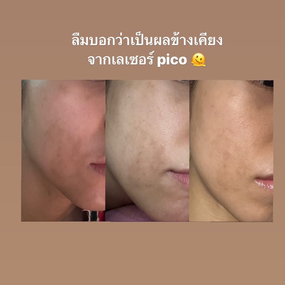 #หนัมว่าดี on Twitter: "สาเหตุที่ต้องเปลี่ยนสกินแคร์ใหม่หมด แล้วงดใช้พวกผลัดเซลล์ผิวไปเลยเพราะ ...