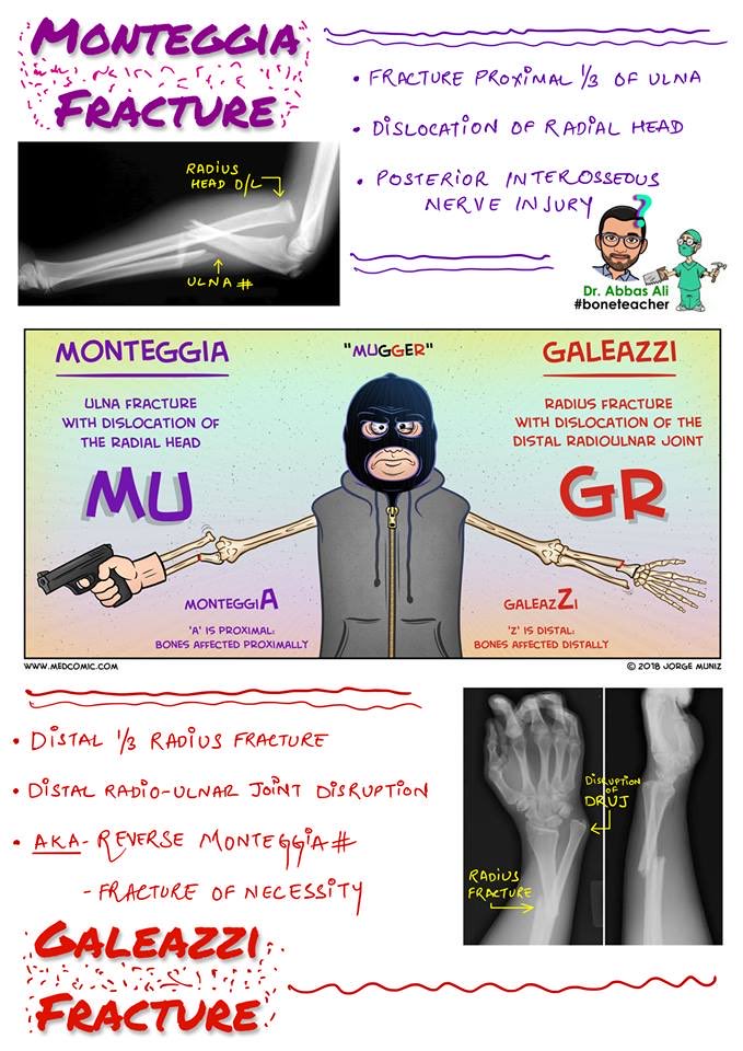 Monteggia Y Galeazzi Monteggia Fracture: Practice Essentials, Anatomy,
