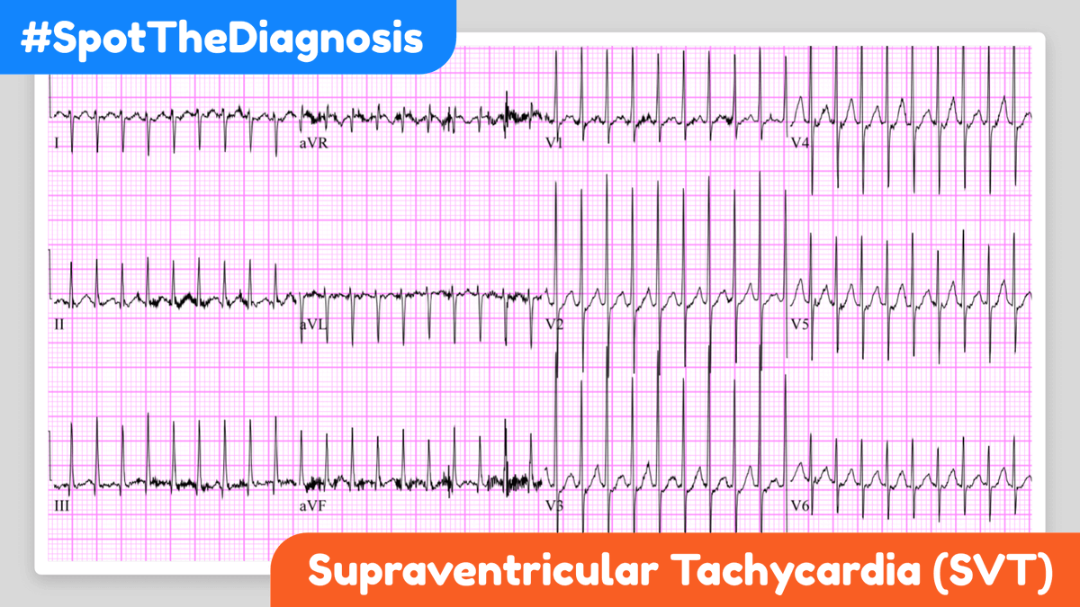 Svt Pediatrics