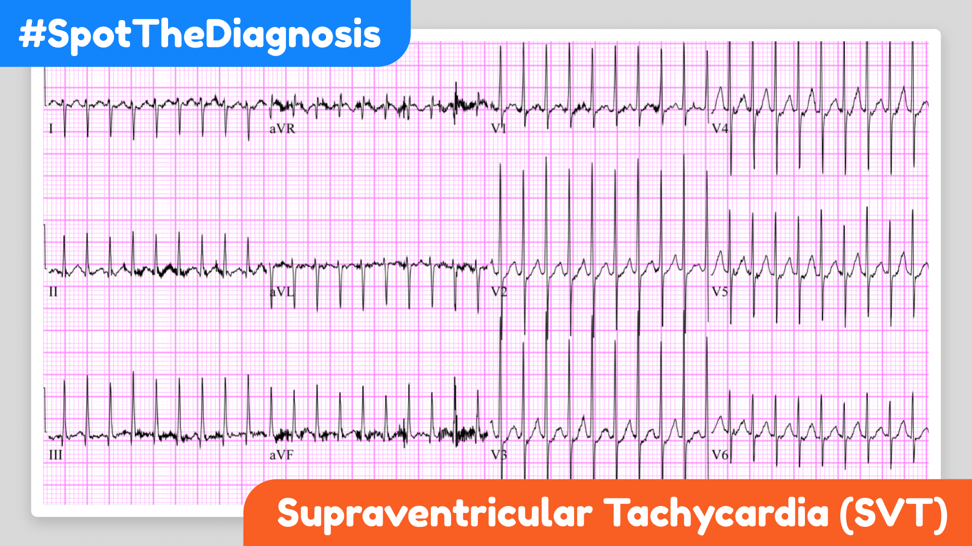 Ecg Svt Pediatrico