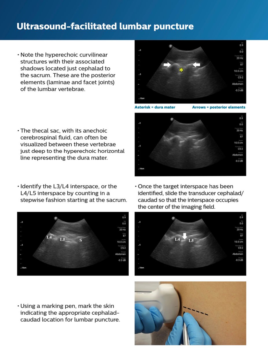 Weekend learning: #POCUS guided lumbar puncture. Courtesy: Dr. Stone ...