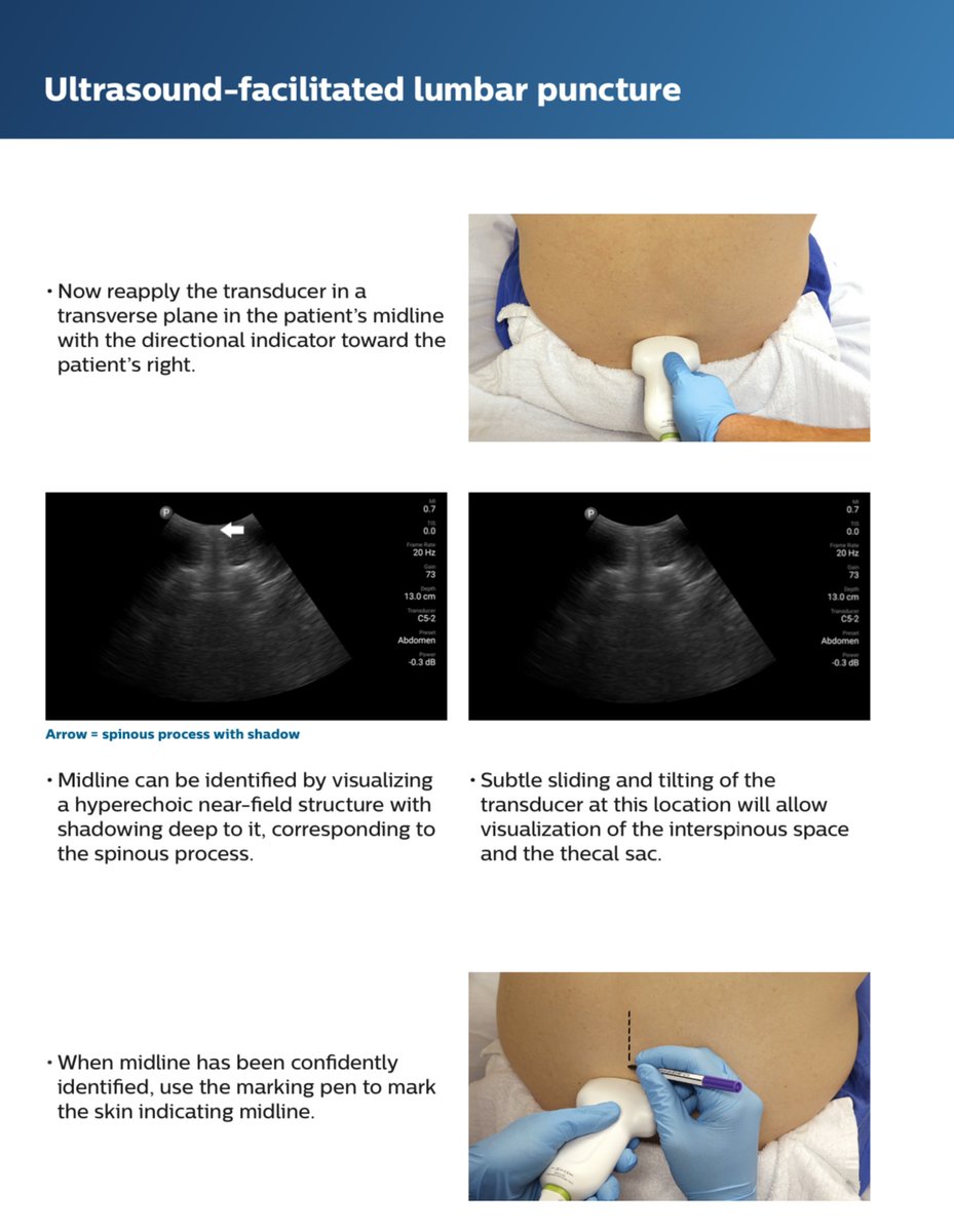 Weekend learning: #POCUS guided lumbar puncture. Courtesy: Dr. Stone ...