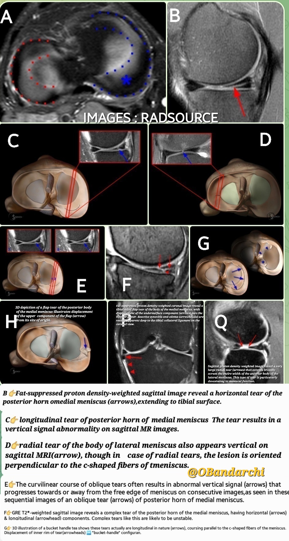 Lateral Meniscus Tear Posterior Horn
