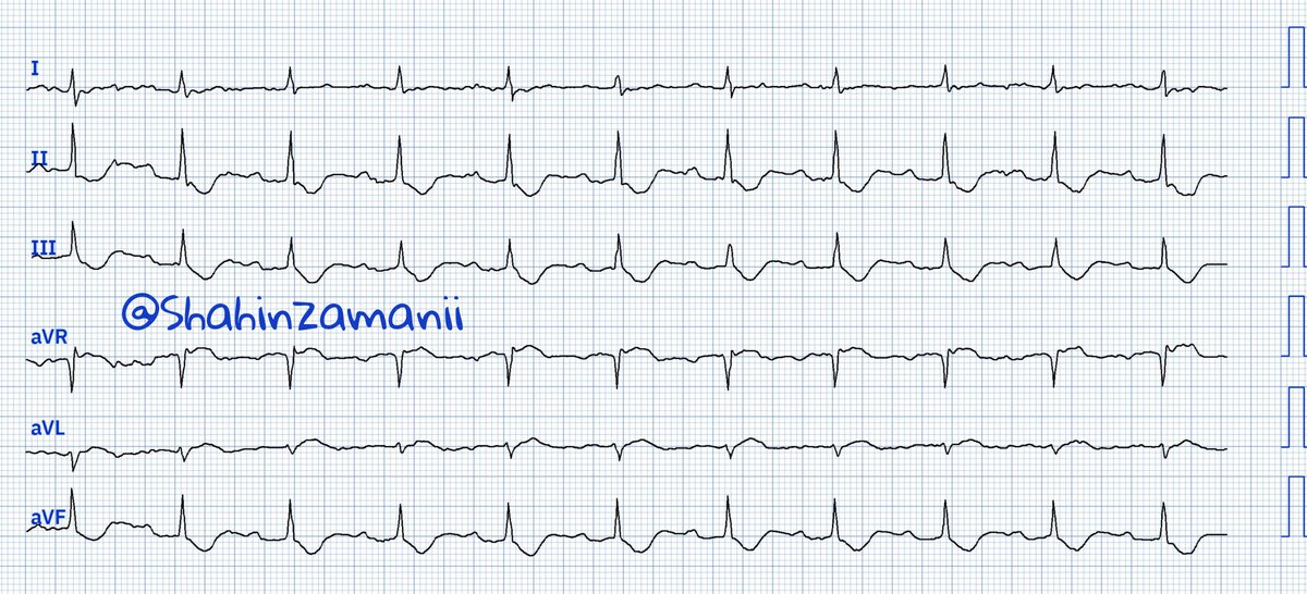 70y.o male, with weakness, abdominal pain + drowsiness. (Degree of ...