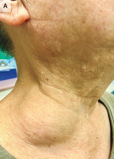 66-year-old man 1-month history of a progressively enlarging mass on ...