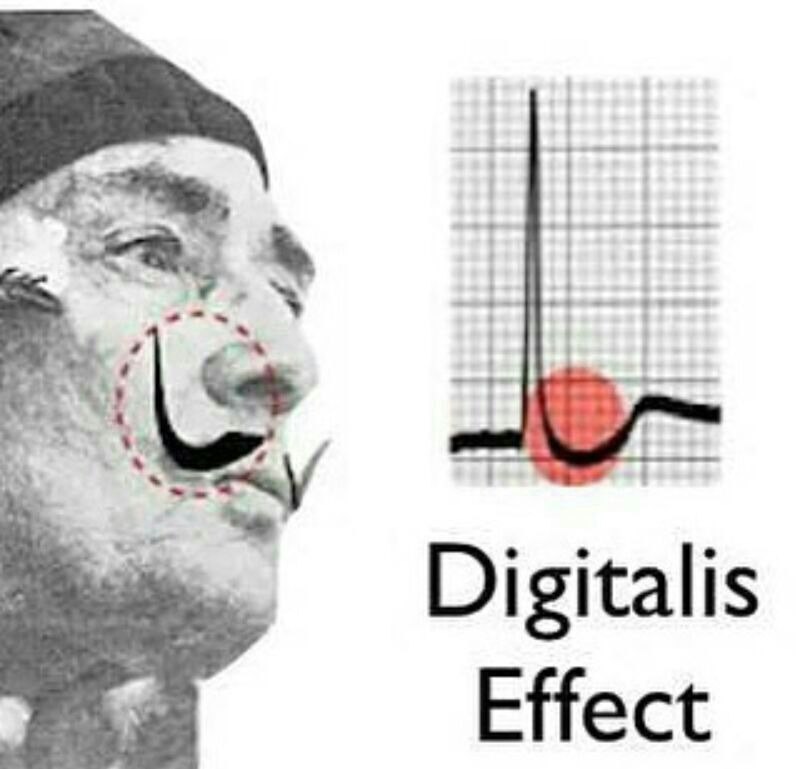 70y.o male, with weakness, abdominal pain + drowsiness. (Degree of ...