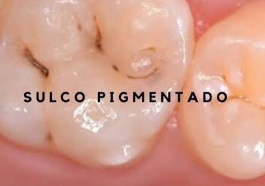Dente Sulco