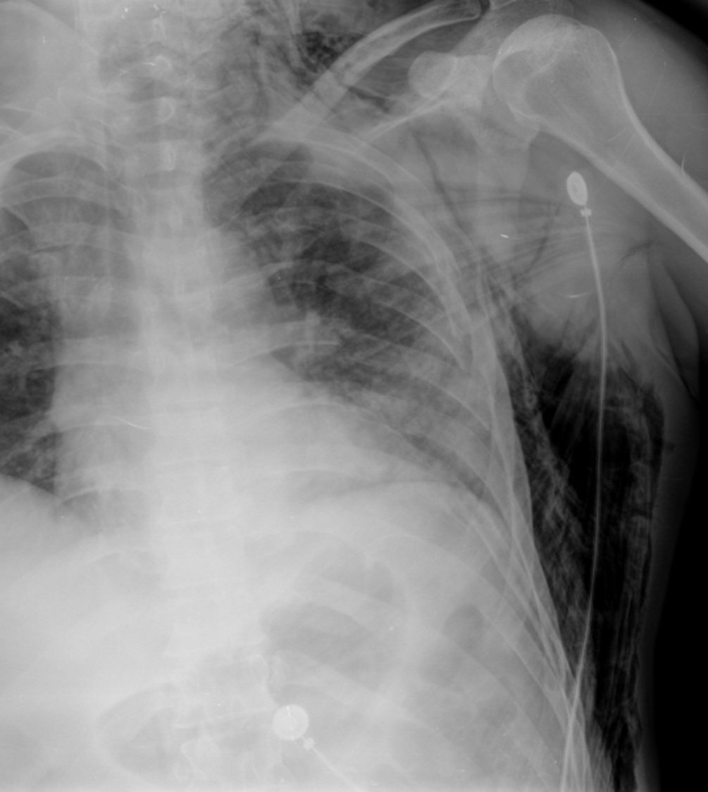 Flail Chest X Ray