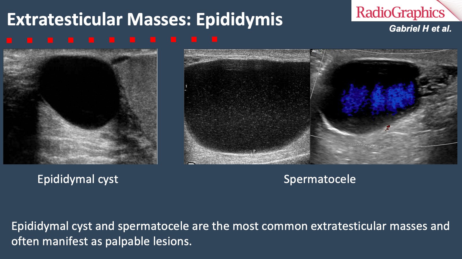 Incidentally Detected Epididymal Cysts And Spermatoceles Sarah