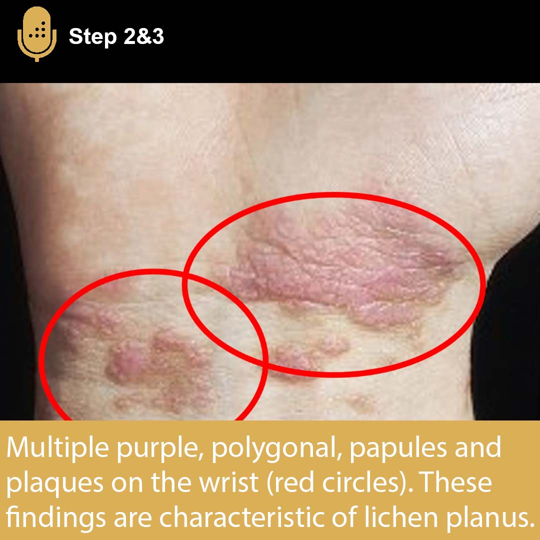 Plaque Lichen Planus