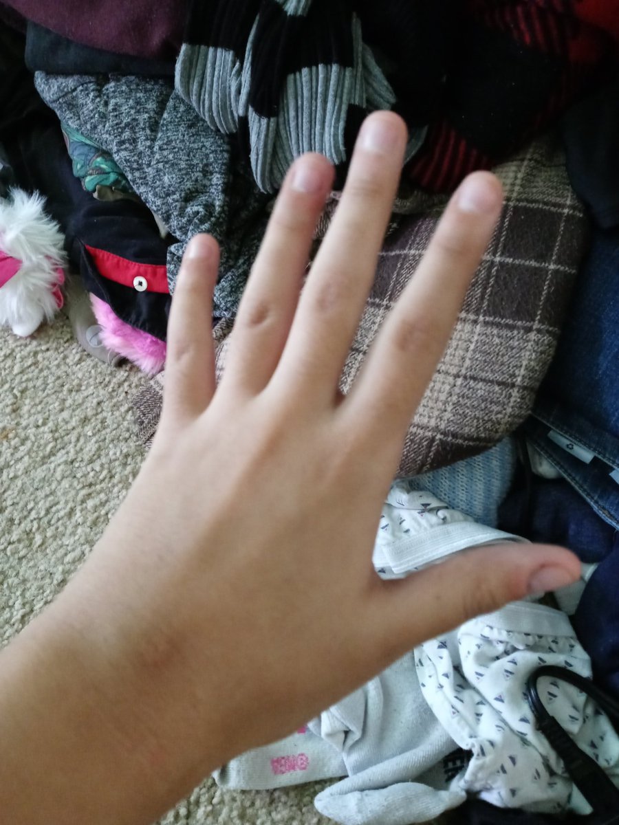 Elvern 🌲forestelfvtuber🌲 On Twitter Describe My Hand In One Sentence😁