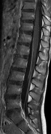 Guillain-Barré syndrome in this child with ascending muscle paralysis ...