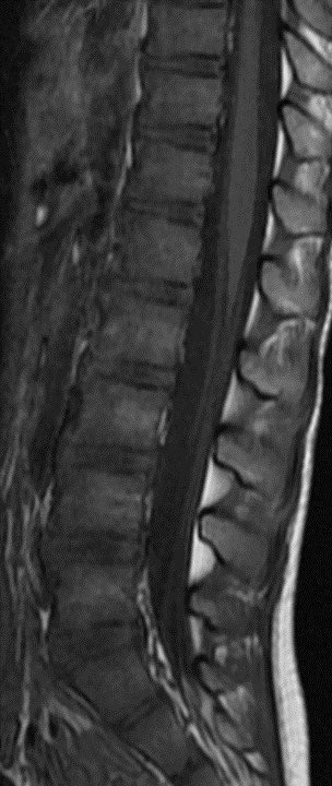 Guillain-Barré syndrome in this child with ascending muscle paralysis ...