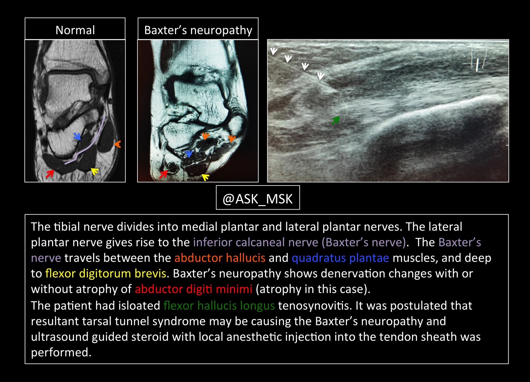 Abductor Digiti Minimi Mri