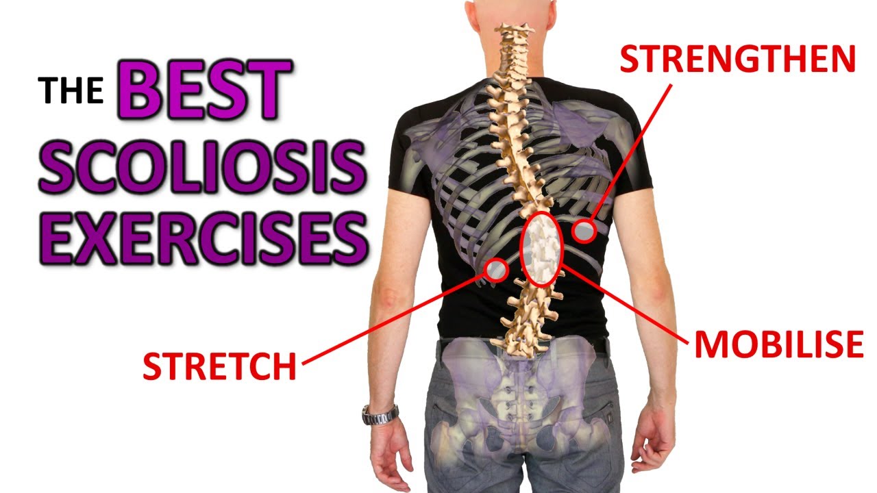 Scoliosis Exercises To Straighten Spine