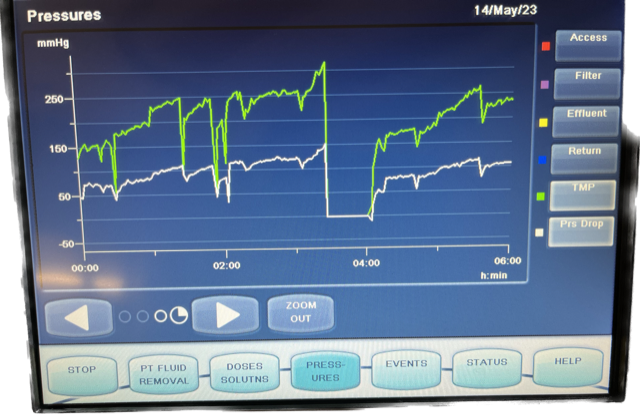 CRRT filter down twice last night due to ⬆️⬆️TMP, same thing happening ...