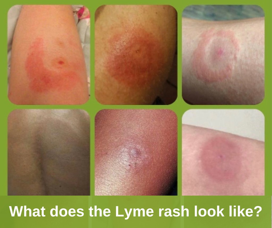 Lyme Disease Bulls Eye Skin Rashes Bay Area Lyme Foundation