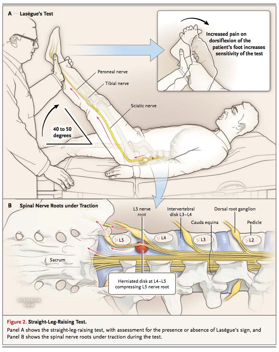 Straight Leg Raise Test