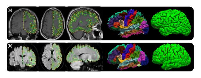 Daily AI Papers on Twitter: "Cortical analysis of heterogeneous clinical brain MRI scans for ...