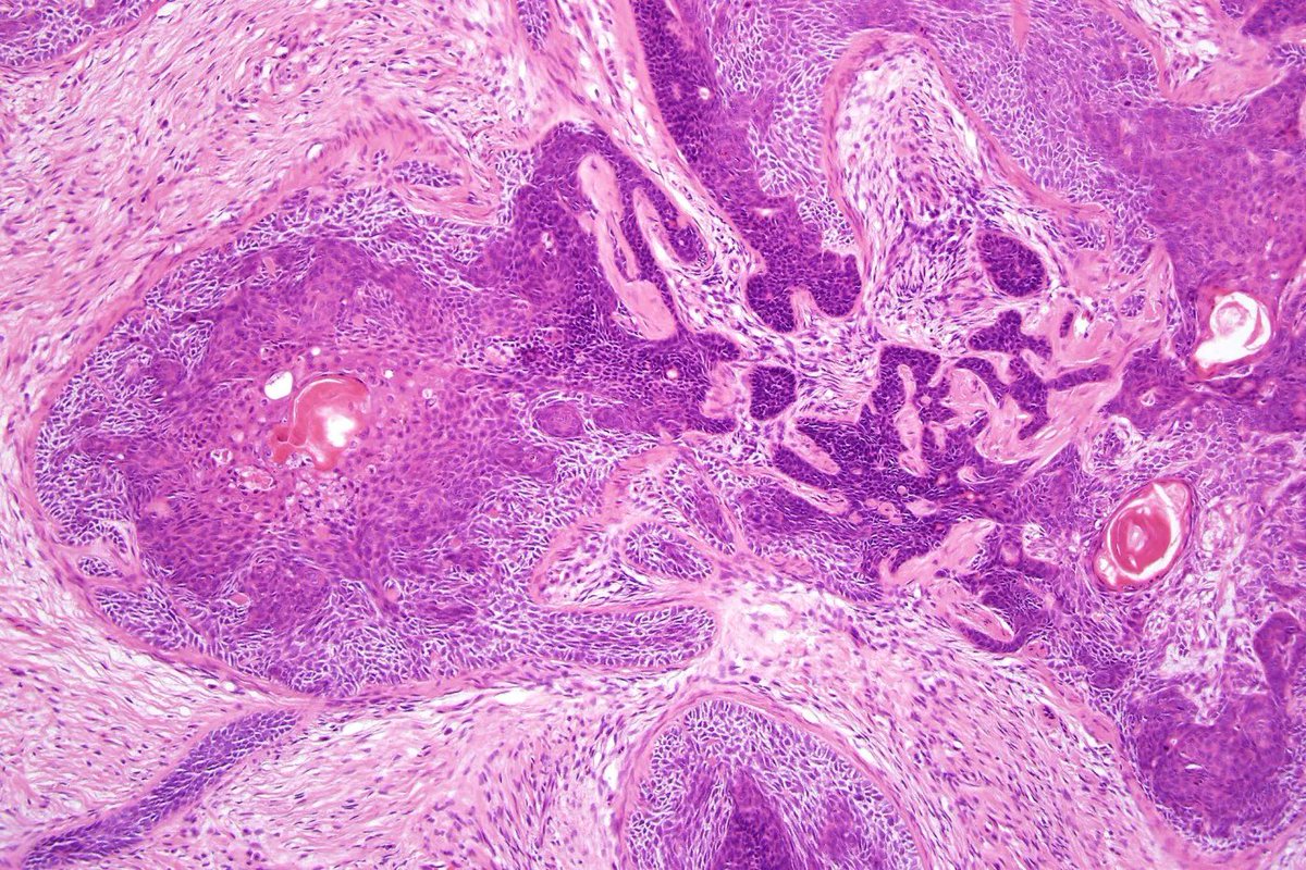 Kiko On Twitter Skin Case From Drs Mckee And Calonje What Is It More