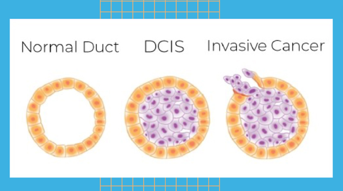 Paolo Tarantino on Twitter: "RT @DFCI_BreastOnc: Did you know that Ductal Carcinoma in Situ (# ...