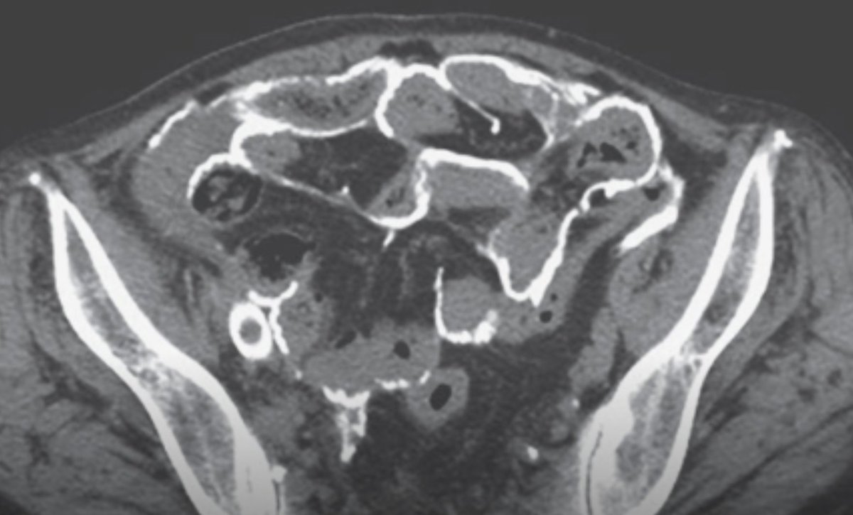 Radrounds Radiology Network On Twitter Diagnosis Source Nejm