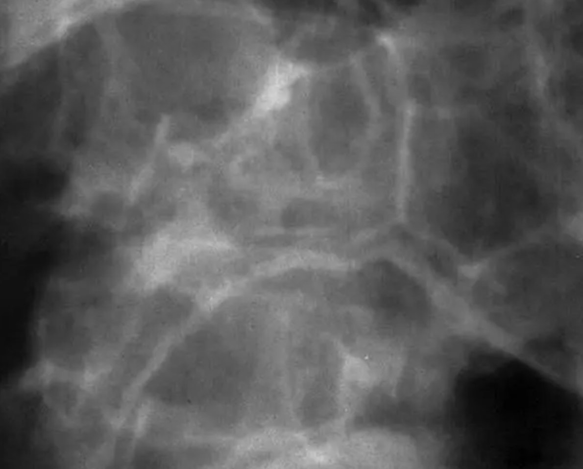 Radrounds Radiology Network On Twitter What Sign Is Seen Here