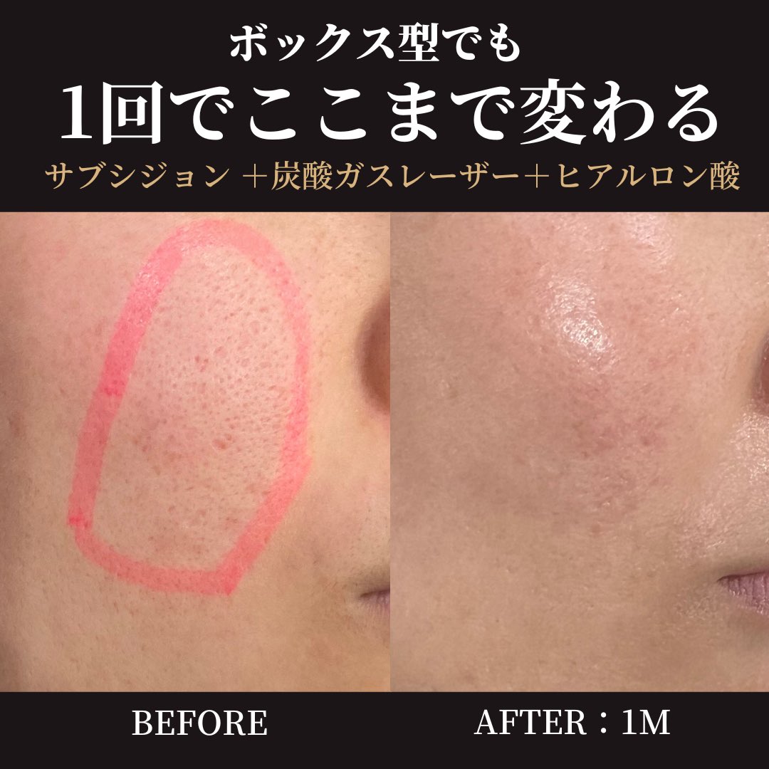 グランメドクリニック茨木 院長岡田大輔 On Twitter 当院でサブシジョン+炭酸ガスレーザー+ヒアルロン酸を受けられた患者様です。他院様でダーマペン、フラクショナルレーザーなどを受け